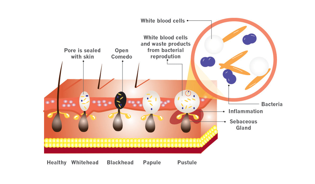 All About Acne and Acne Scars – The Aesthetics Clinic Pte Ltd